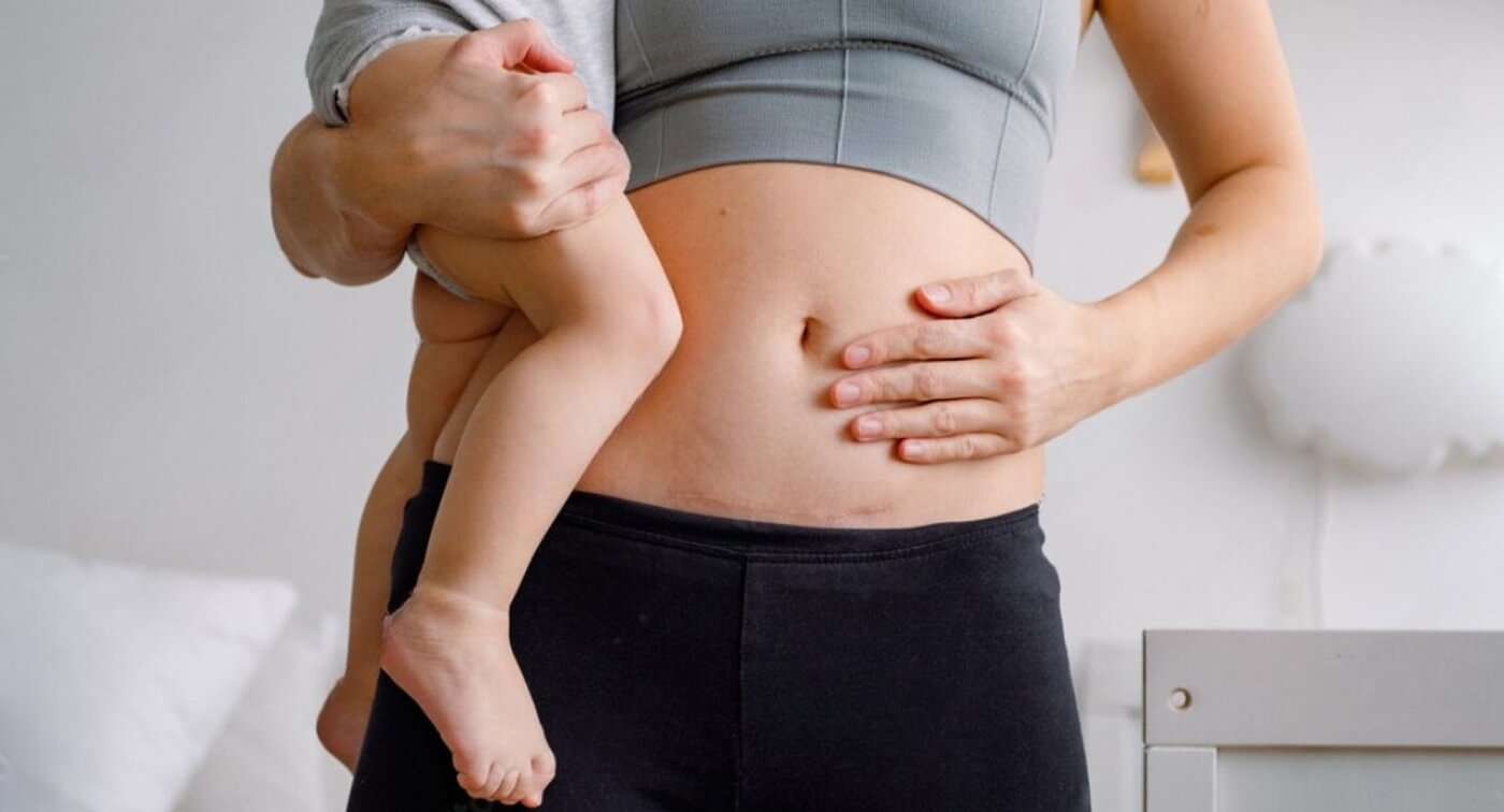 Istmocele uterina: por que ela causa infertilidade? - IVI BR