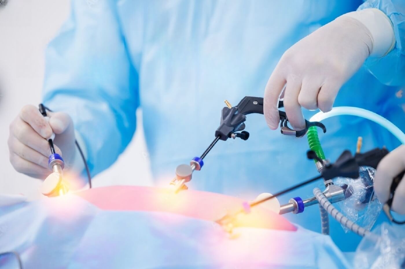 Laparoscopia: como funciona a técnica minimamente invasiva - IVI BR