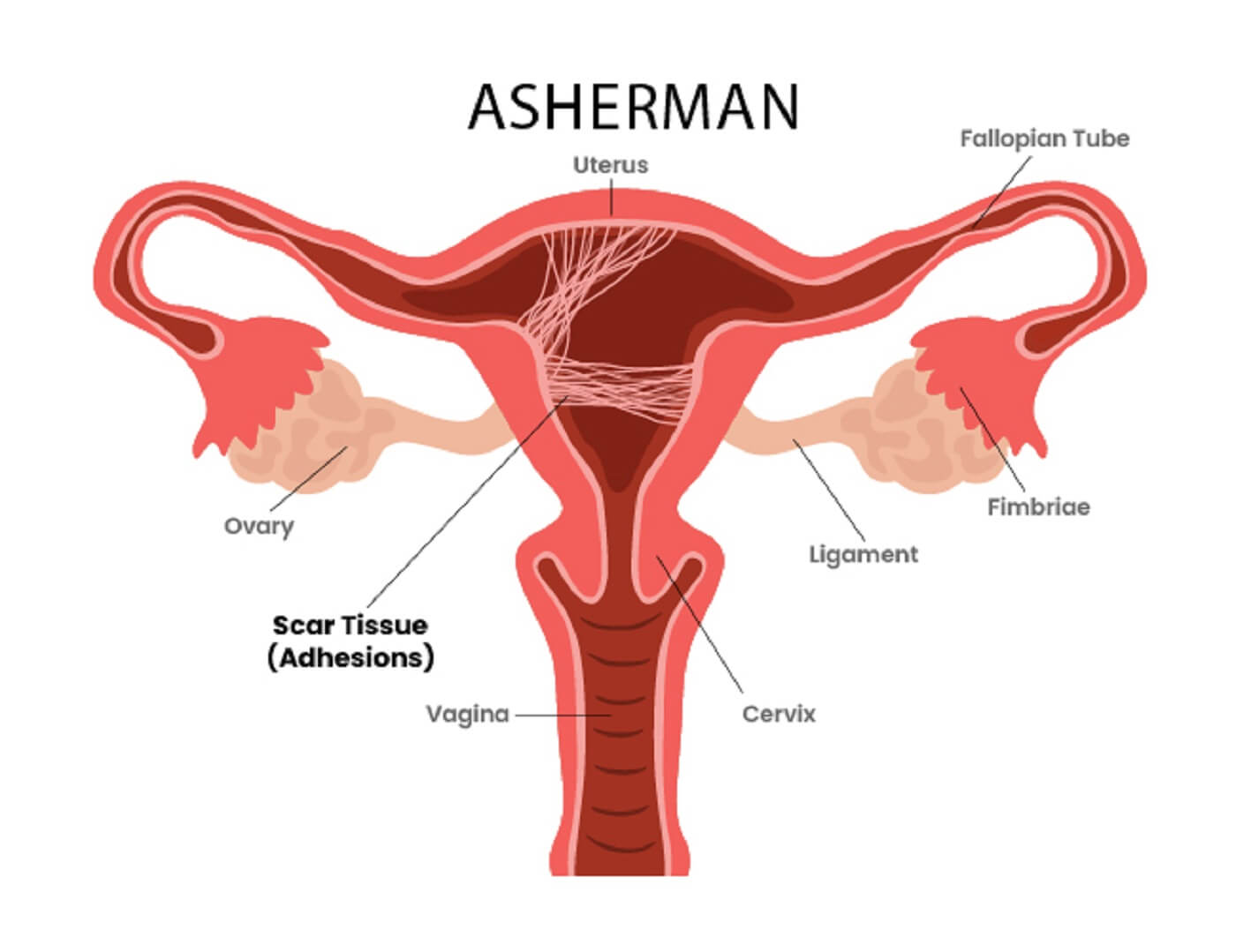 Síndrome de Asherman - IVI BR